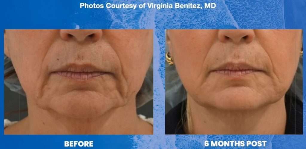 Praxis Dr. Kurscheid | Hautstraffung mit Sofwave™